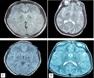 AJNS – African Journal of Neurological Sciences | » PANTOTHENATE KINASE ...