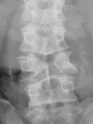 AJNS – African Journal of Neurological Sciences | » BUTTERFLY VERTEBRA ...