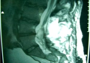 AJNS – African Journal of Neurological Sciences | » BUTTERFLY VERTEBRA ...