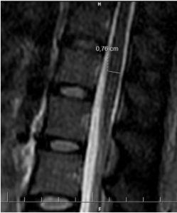 AJNS – African Journal of Neurological Sciences | » TERMINAISON DU CÔNE ...