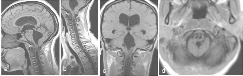 AJNS – African Journal of Neurological Sciences | » PERSISTENT MISSED ...