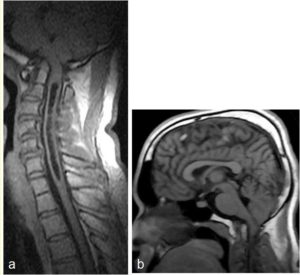 AJNS – African Journal of Neurological Sciences | » PERSISTENT MISSED ...