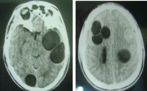 AJNS – African Journal of Neurological Sciences | » LE KYSTE HYDATIQUE ...